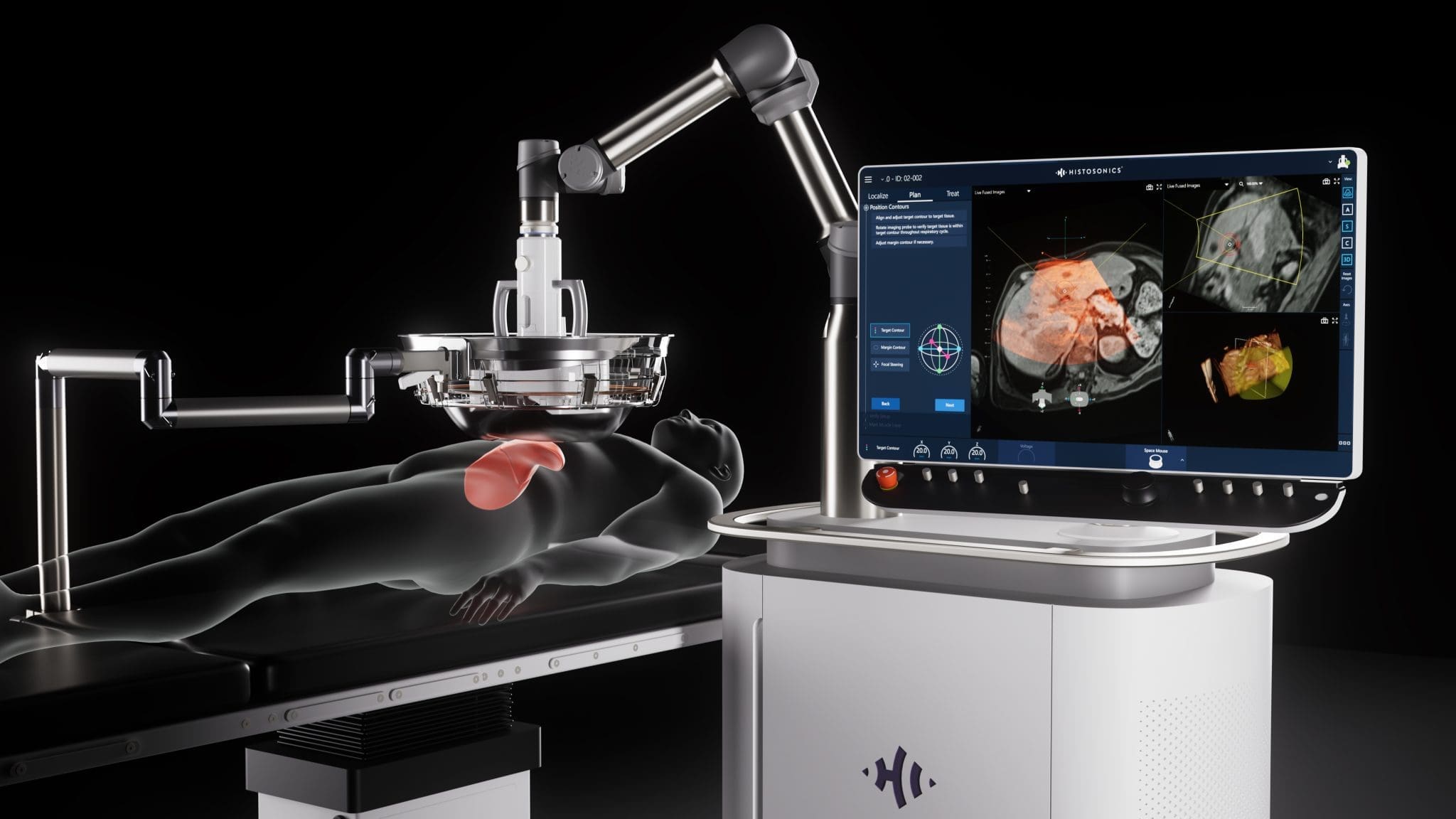 UM Health-West introduces histotripsy, cutting-edge ultrasonic cancer ...